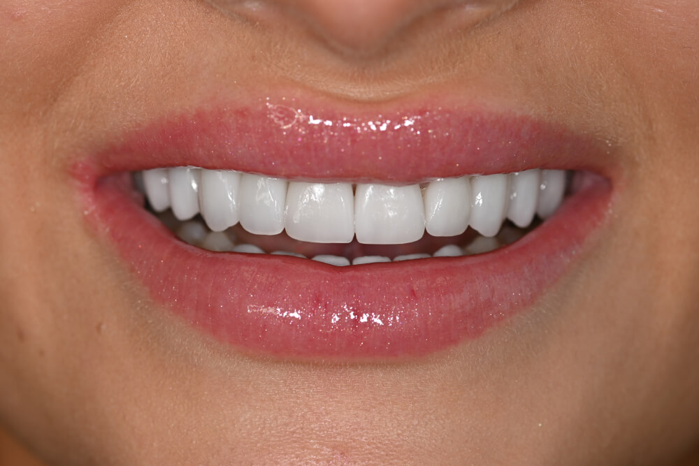 Smile Gallery | Transformations by Modern Bite Dentistry